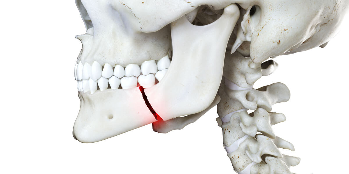 Facial Trauma - Sedaros Oral Surgery
